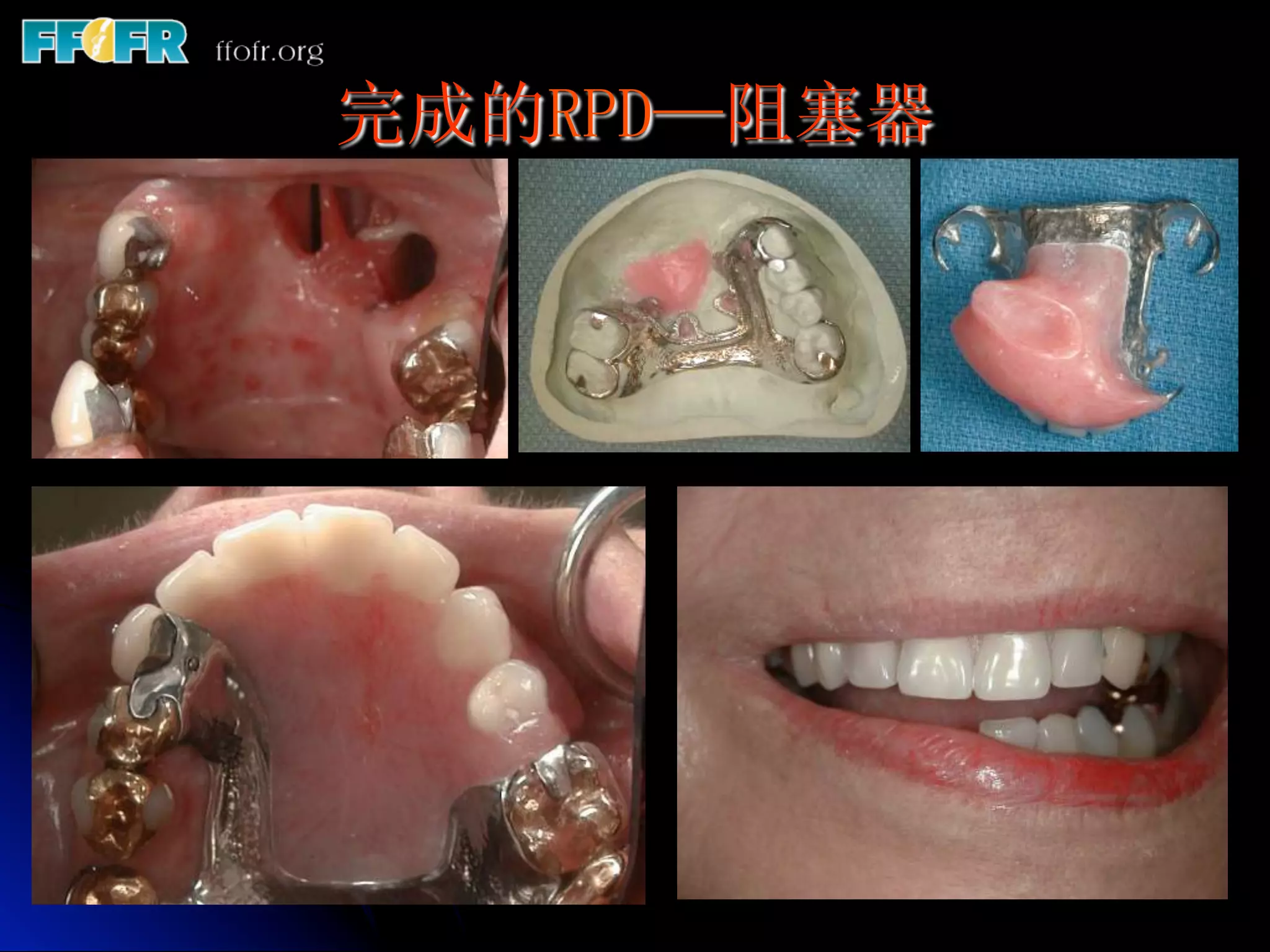 16.mfp defects and rpd design | PPT