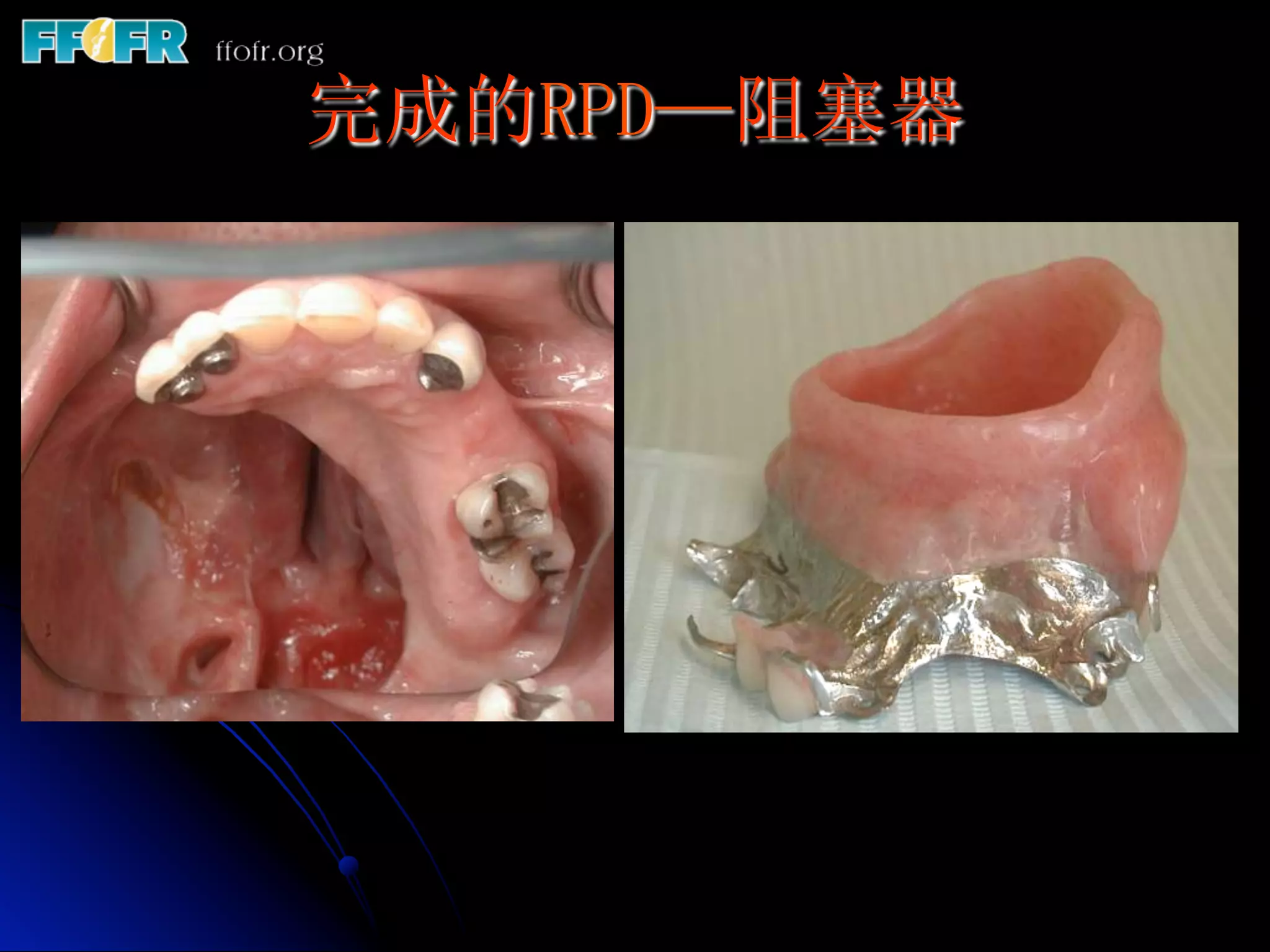 16.mfp defects and rpd design | PPT