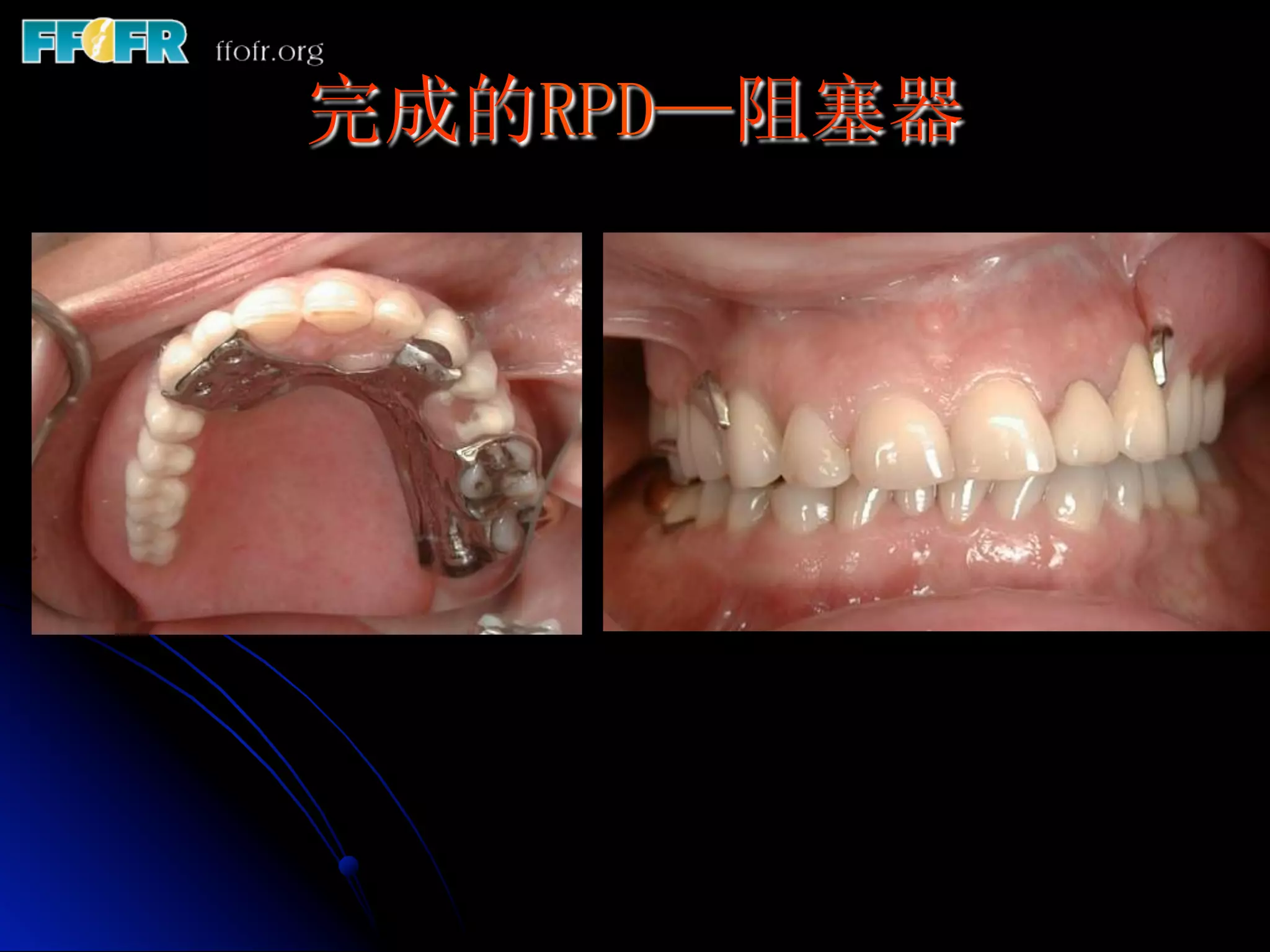 16.mfp defects and rpd design | PPT