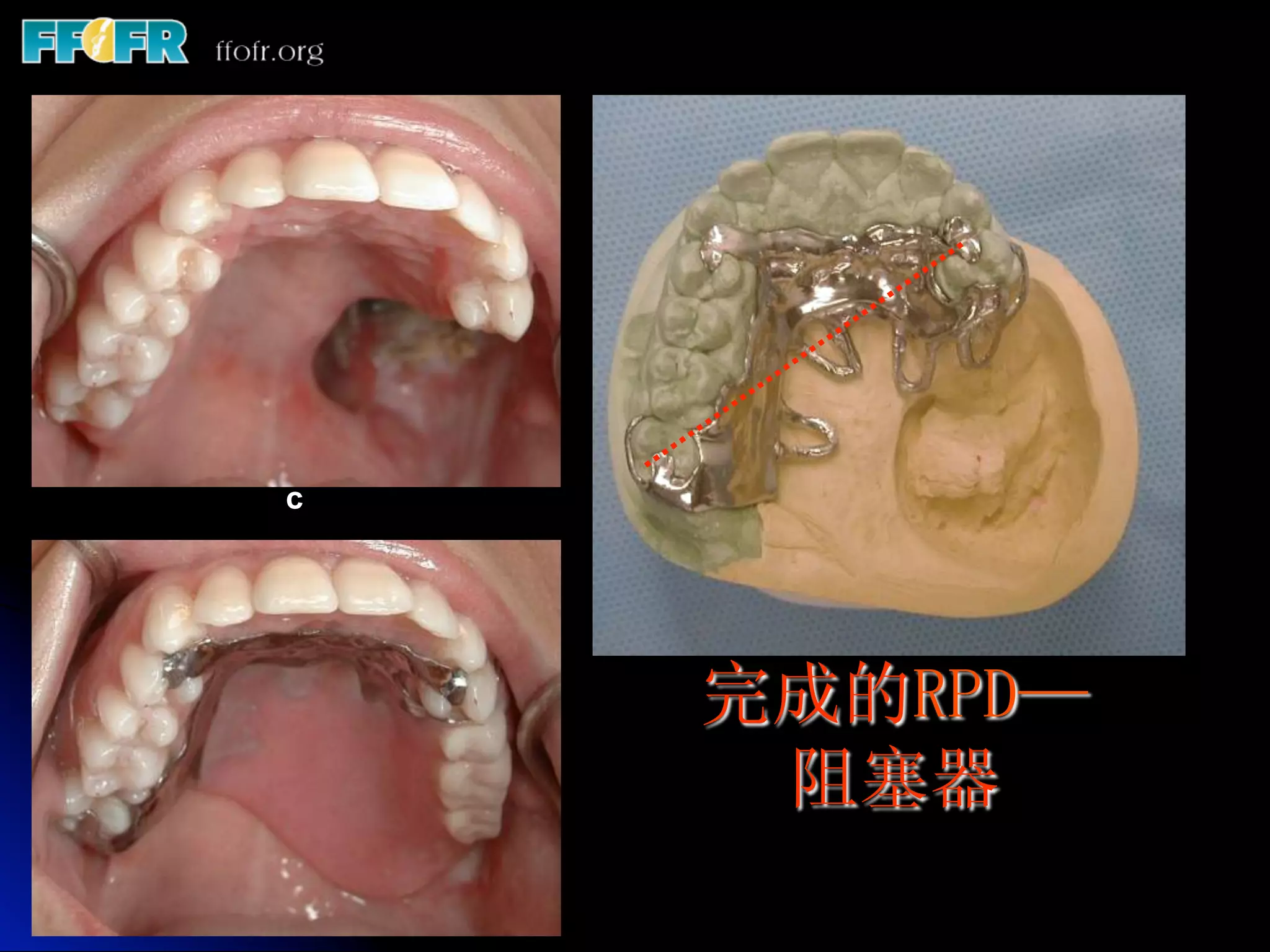 16.mfp defects and rpd design | PPT