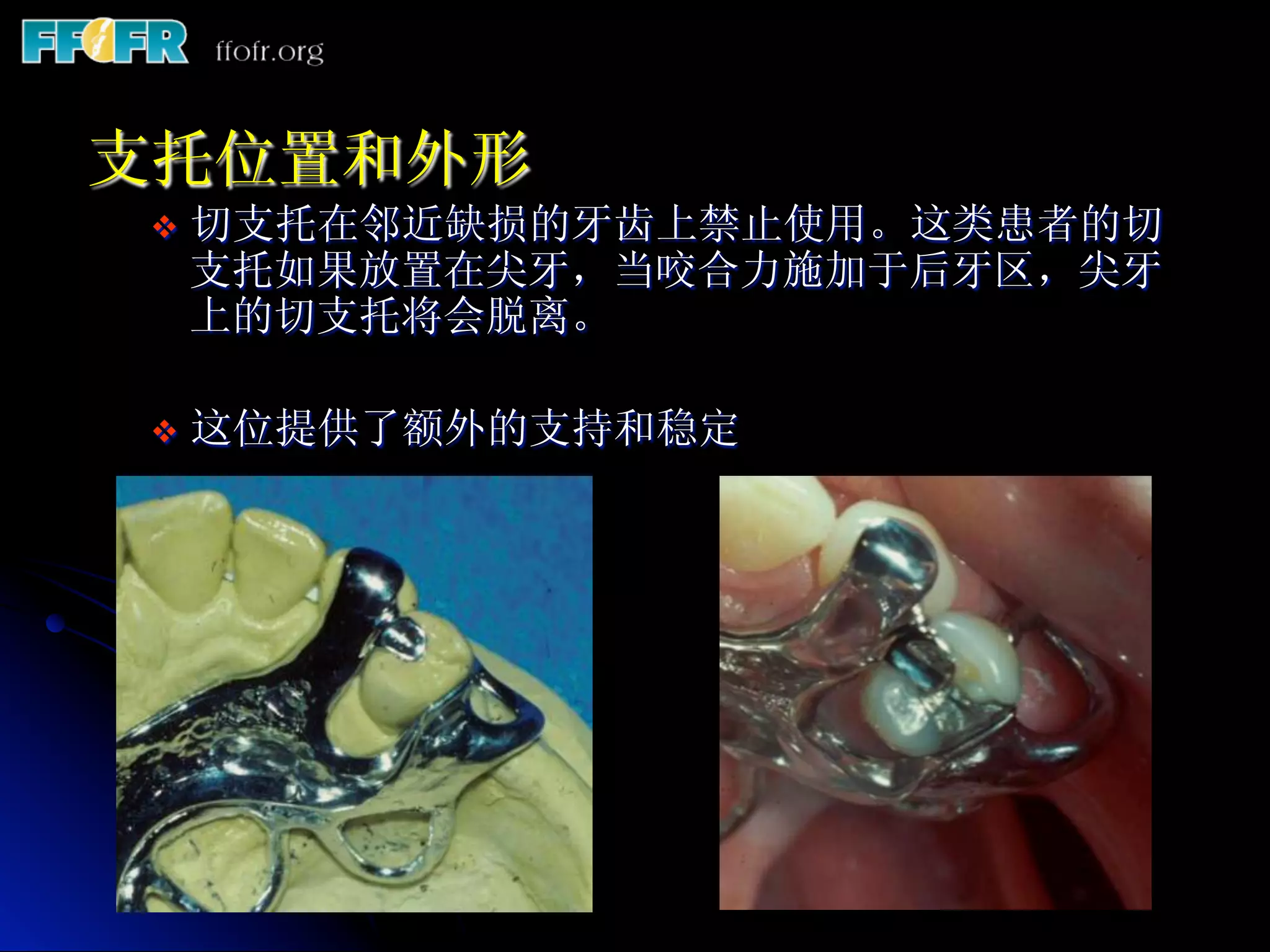 16.mfp defects and rpd design | PPT