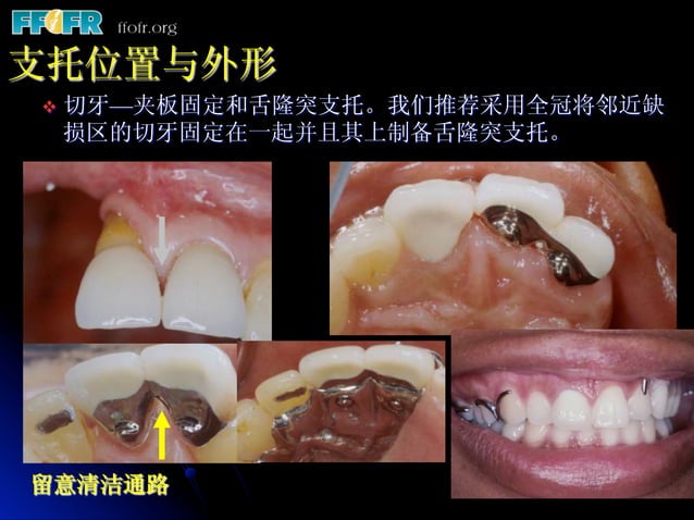 16.mfp defects and rpd design | PPT