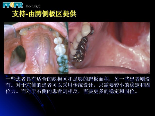 16.mfp defects and rpd design | PPT