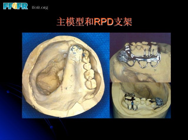 16.mfp defects and rpd design | PPT