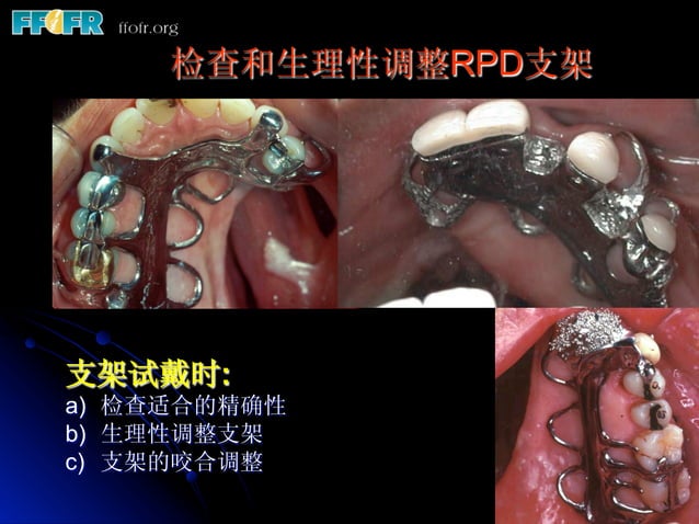16.mfp defects and rpd design | PPT