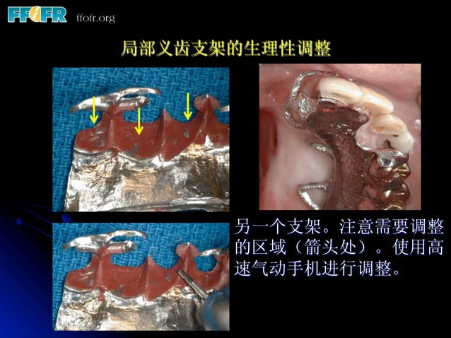 16.mfp defects and rpd design | PPT