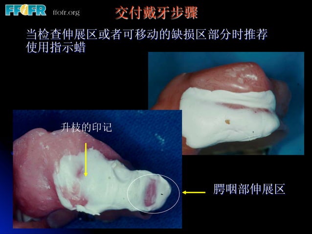 16.mfp defects and rpd design | PPT