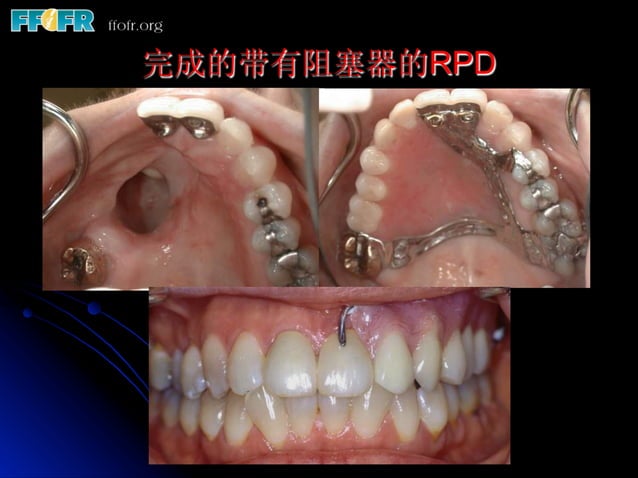 16.mfp defects and rpd design | PPT