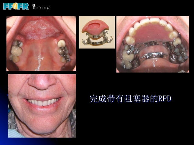 16.mfp defects and rpd design | PPT