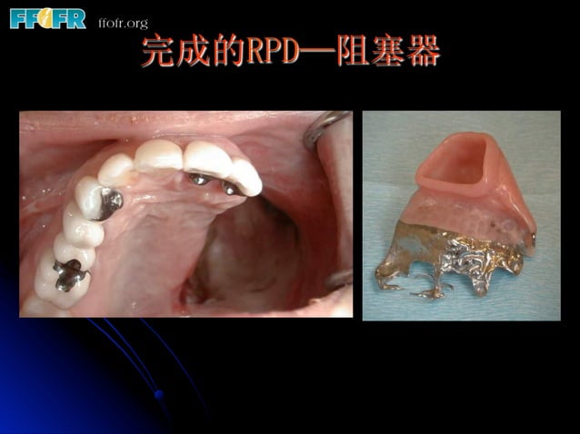 16.mfp defects and rpd design | PPT