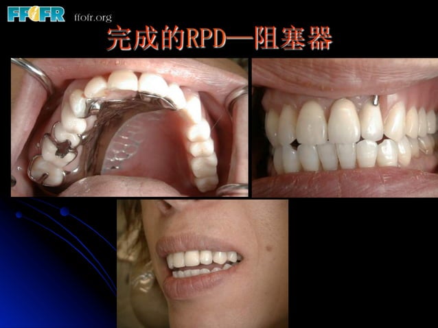 16.mfp defects and rpd design | PPT