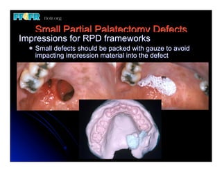 16. (new)maxillary obturators trouble shooting, relines and other ...
