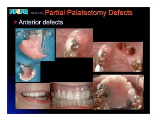 16. (new)maxillary obturators trouble shooting, relines and other ...