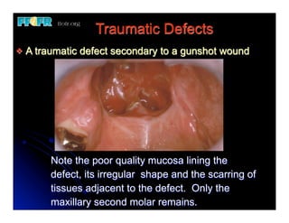 16. (new)maxillary obturators trouble shooting, relines and other ...