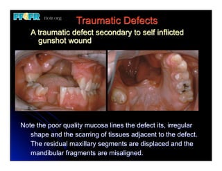 16. (new)maxillary obturators trouble shooting, relines and other ...