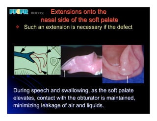 16. (new)maxillary obturators trouble shooting, relines and other ...