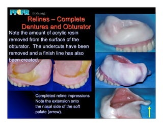 16. (new)maxillary obturators trouble shooting, relines and other ...