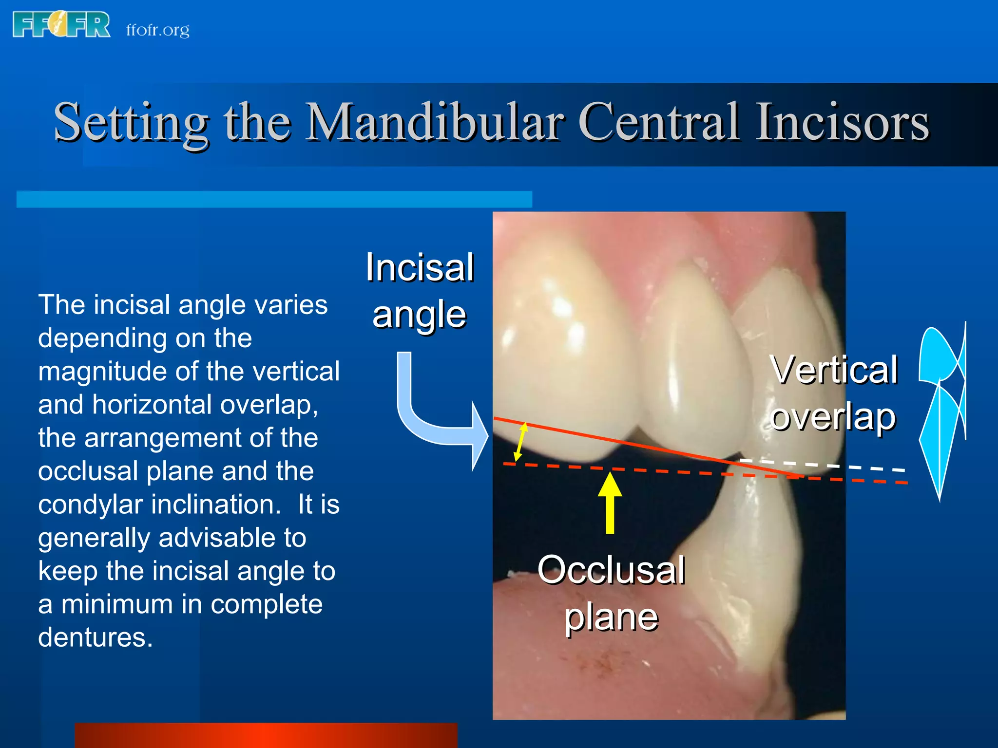 16.occlusal schemes lingualized occlusion | PPT