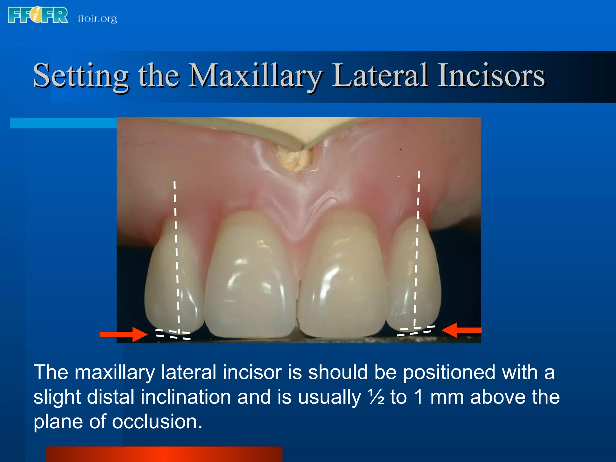 16.occlusal schemes lingualized occlusion | PPT
