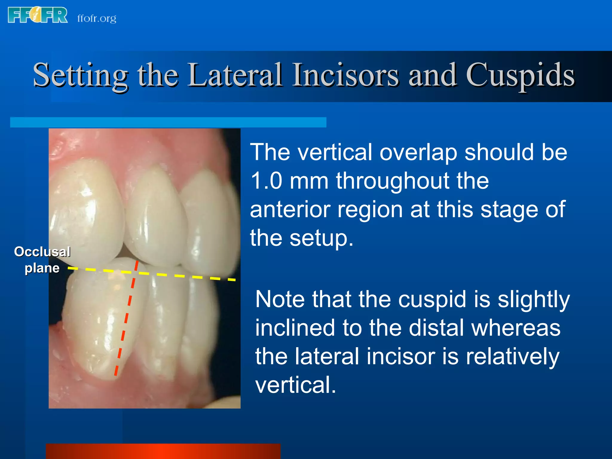 16.occlusal schemes lingualized occlusion | PPT