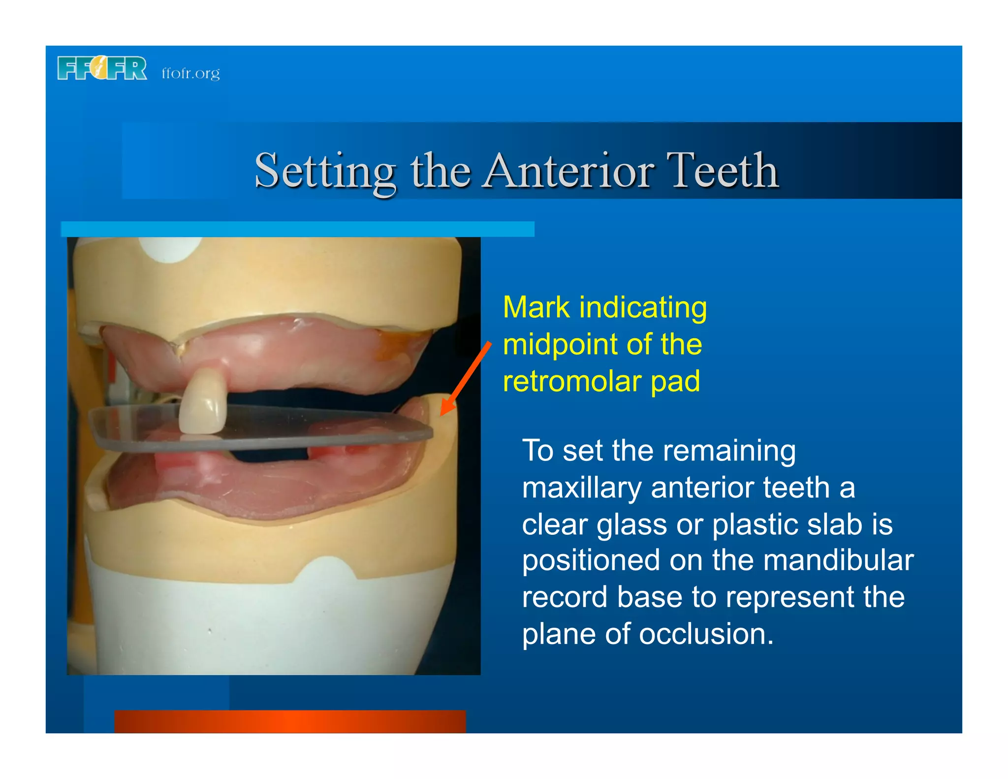 16.occlusal schemes lingualized occlusion | PDF