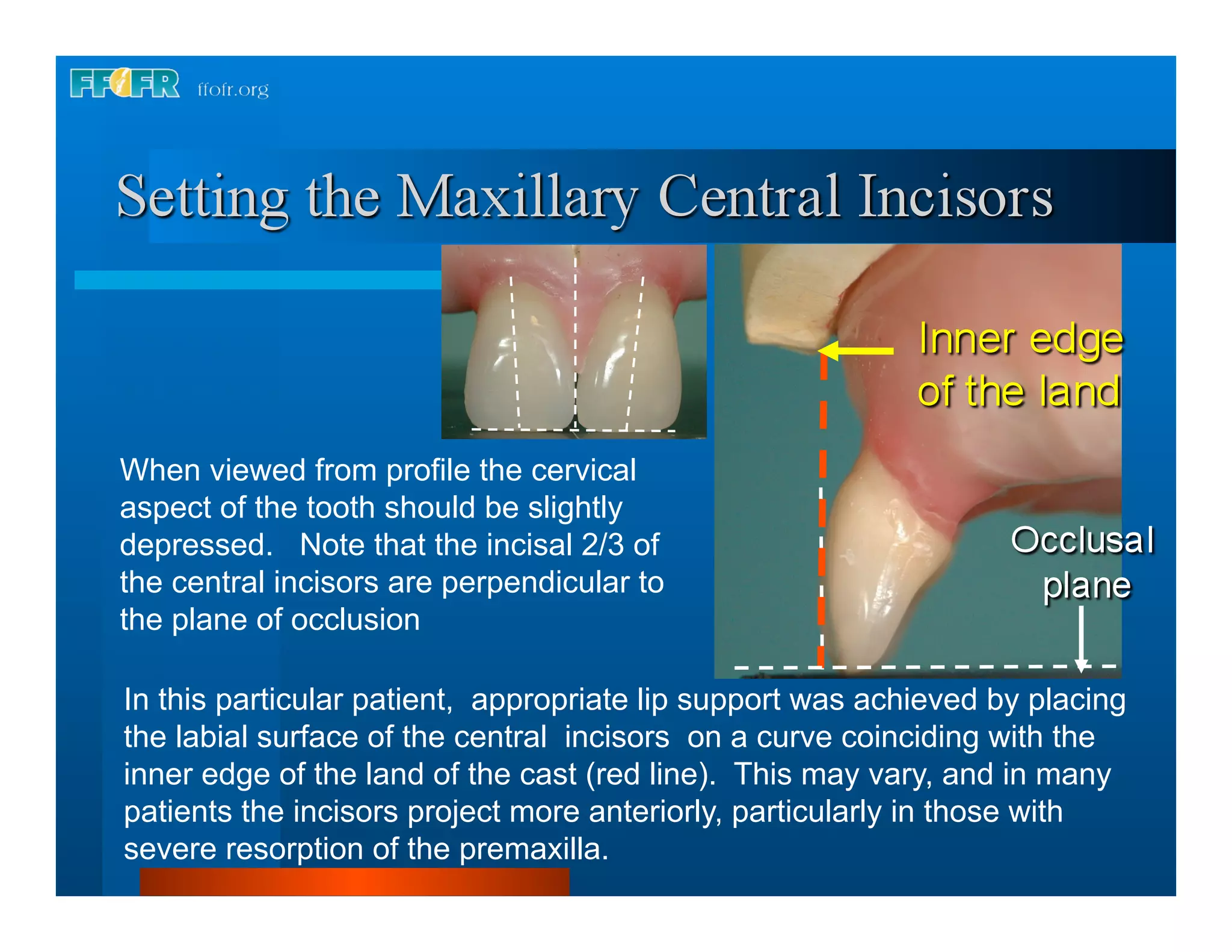16.occlusal schemes lingualized occlusion | PDF