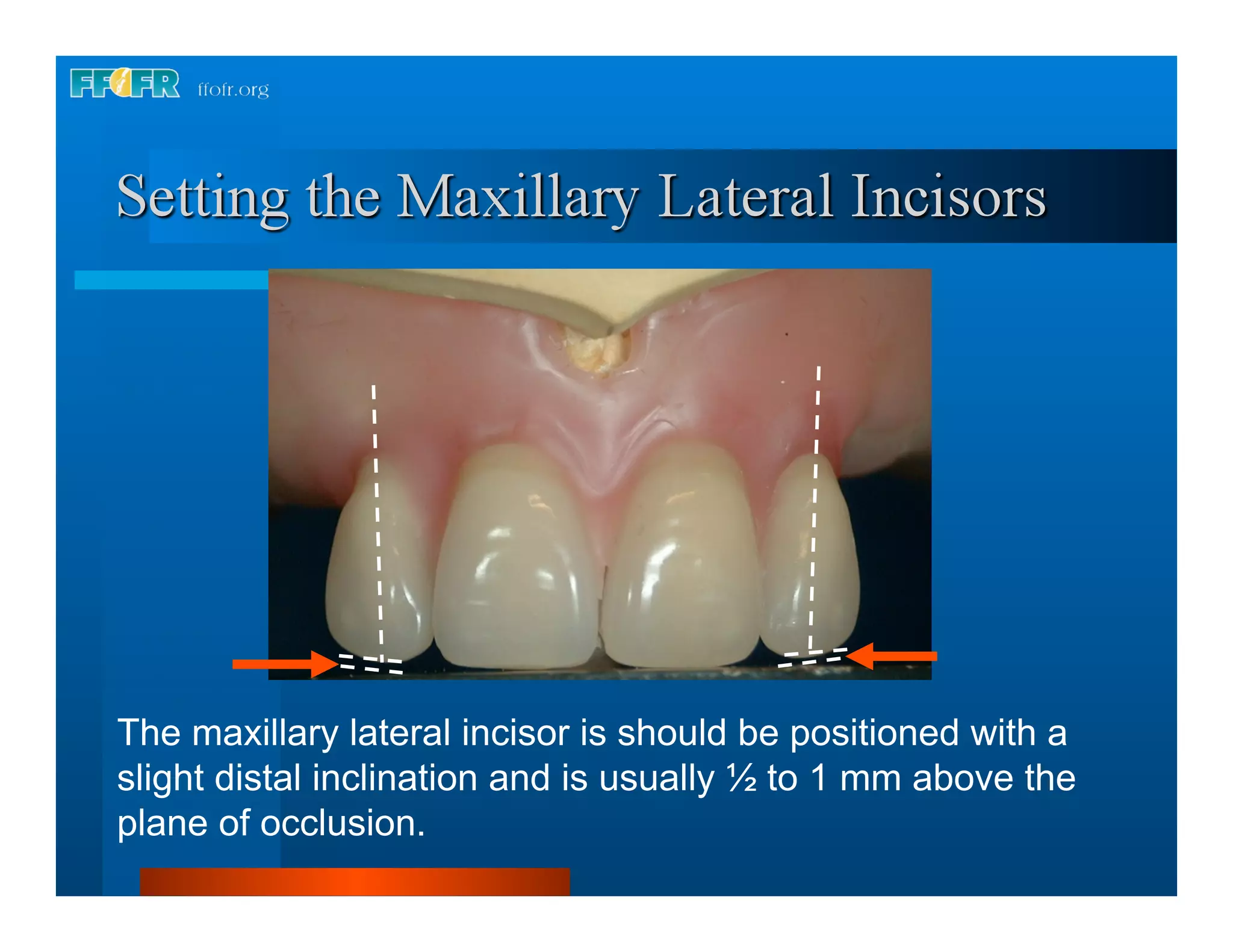 16.occlusal schemes lingualized occlusion | PDF