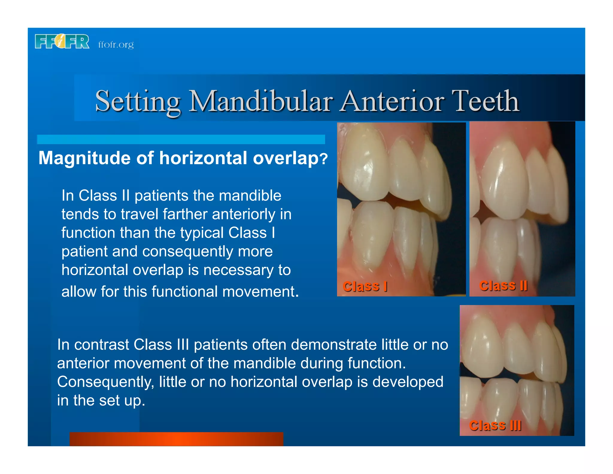 16.occlusal schemes lingualized occlusion | PDF