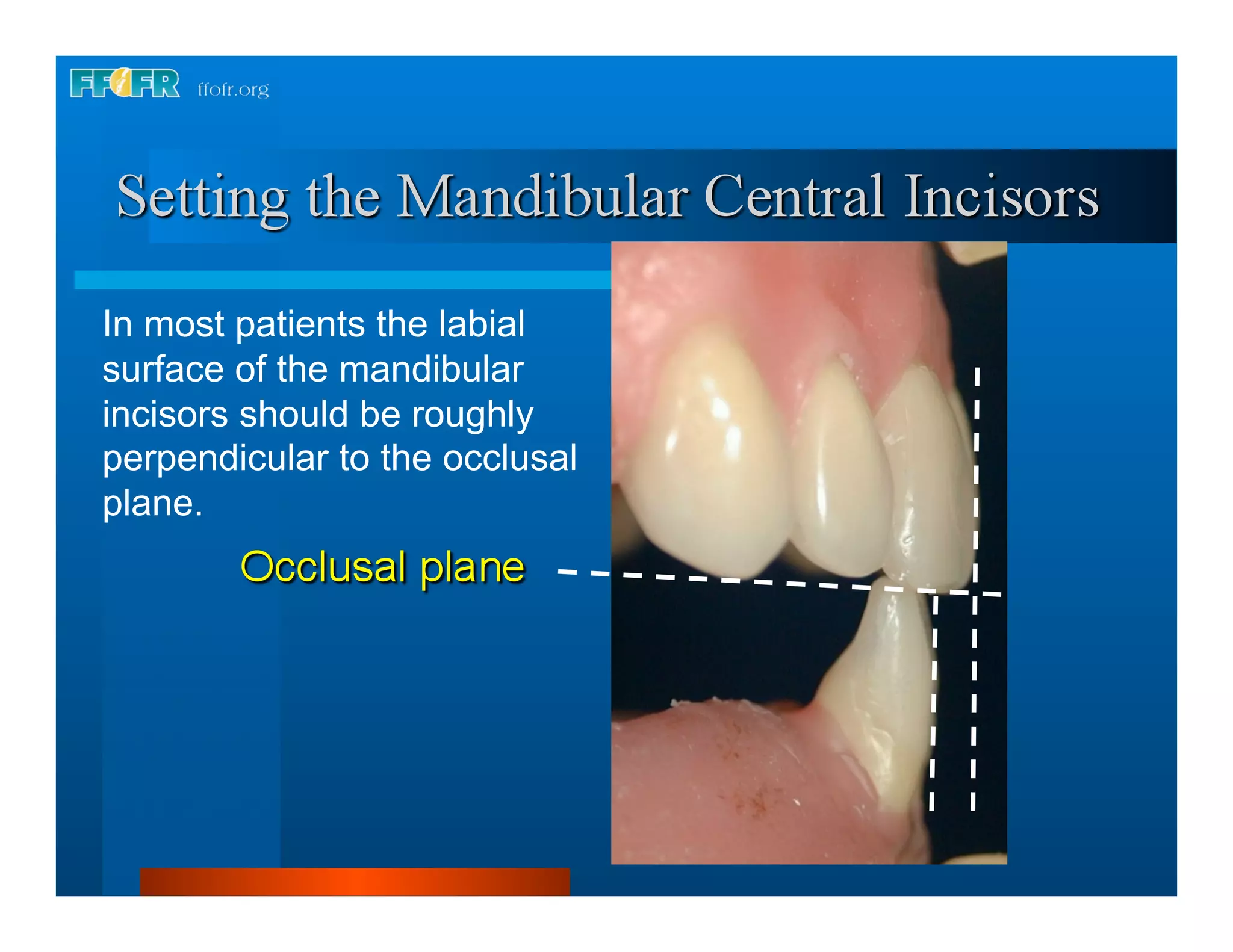 16.occlusal schemes lingualized occlusion | PDF