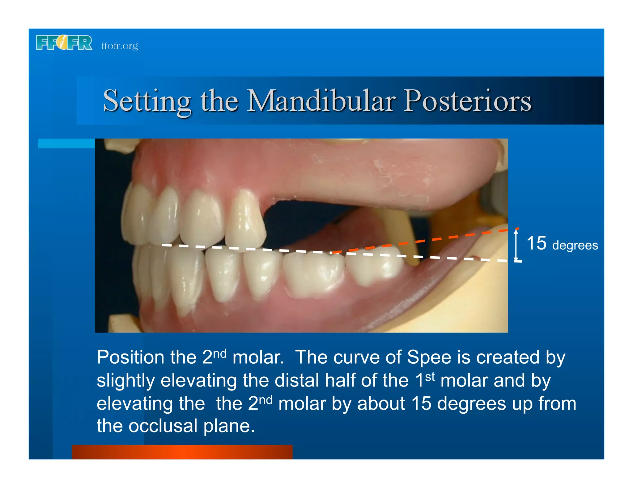 16.occlusal schemes lingualized occlusion | PDF
