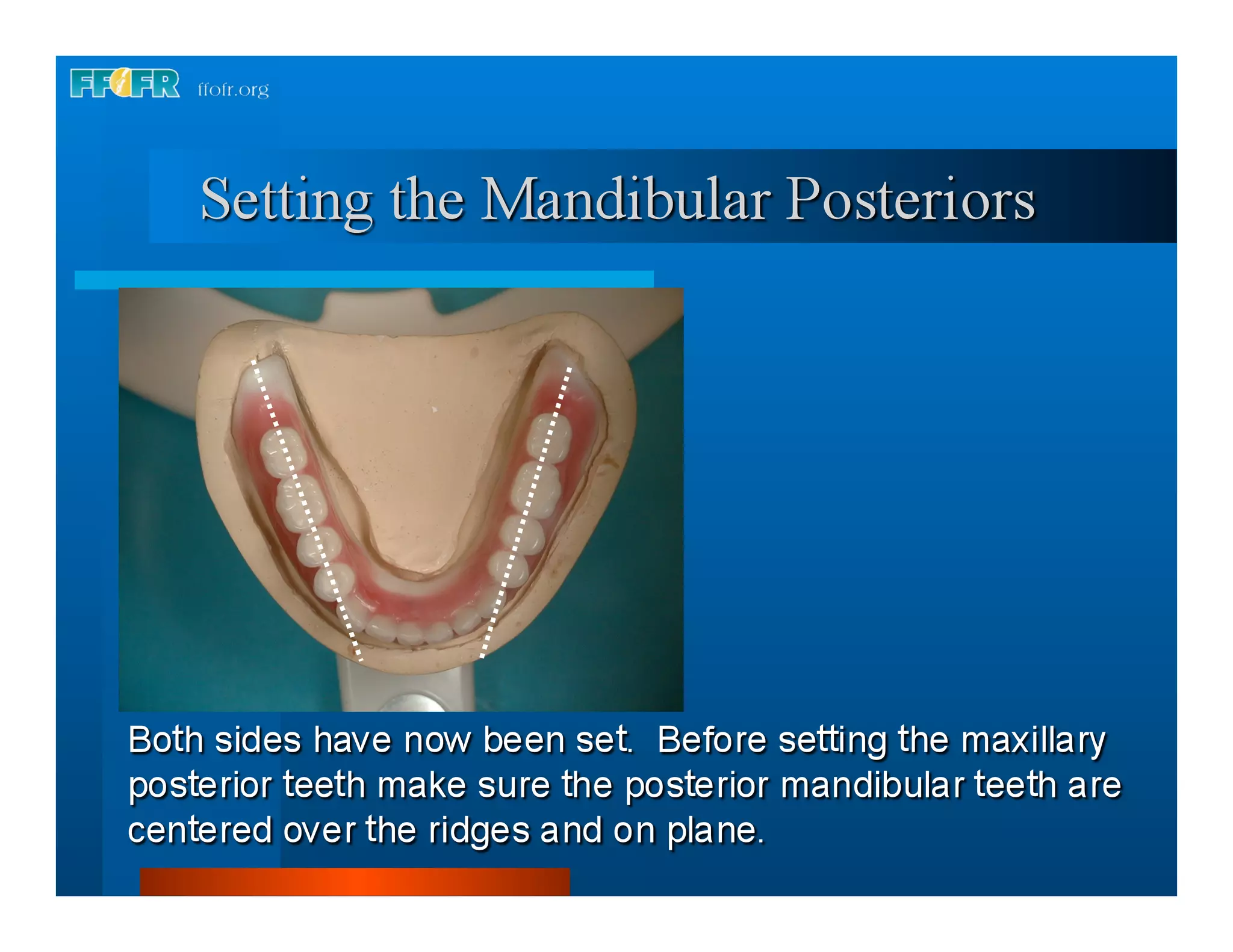 16.occlusal schemes lingualized occlusion | PDF