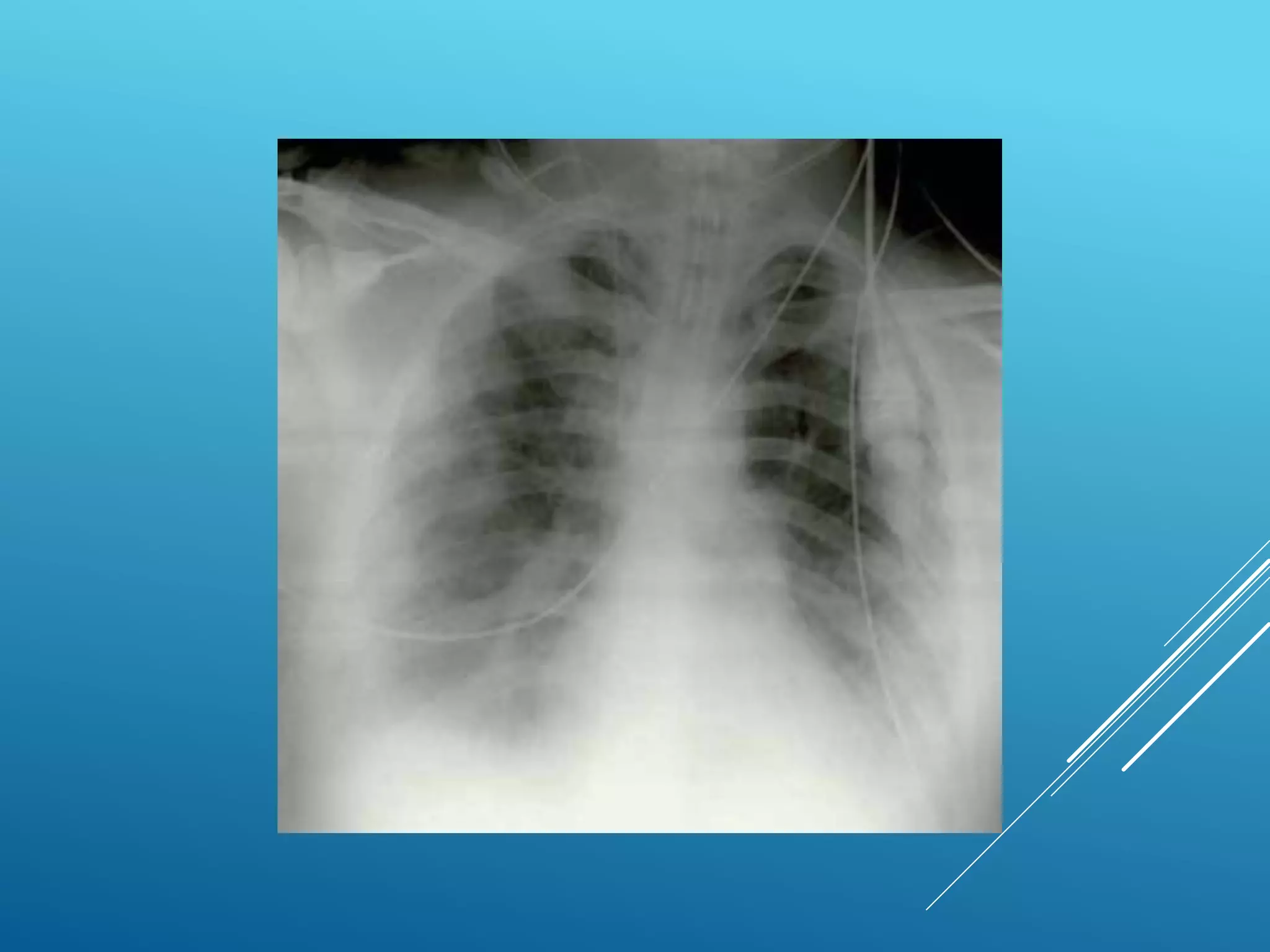blast injury | PPTX