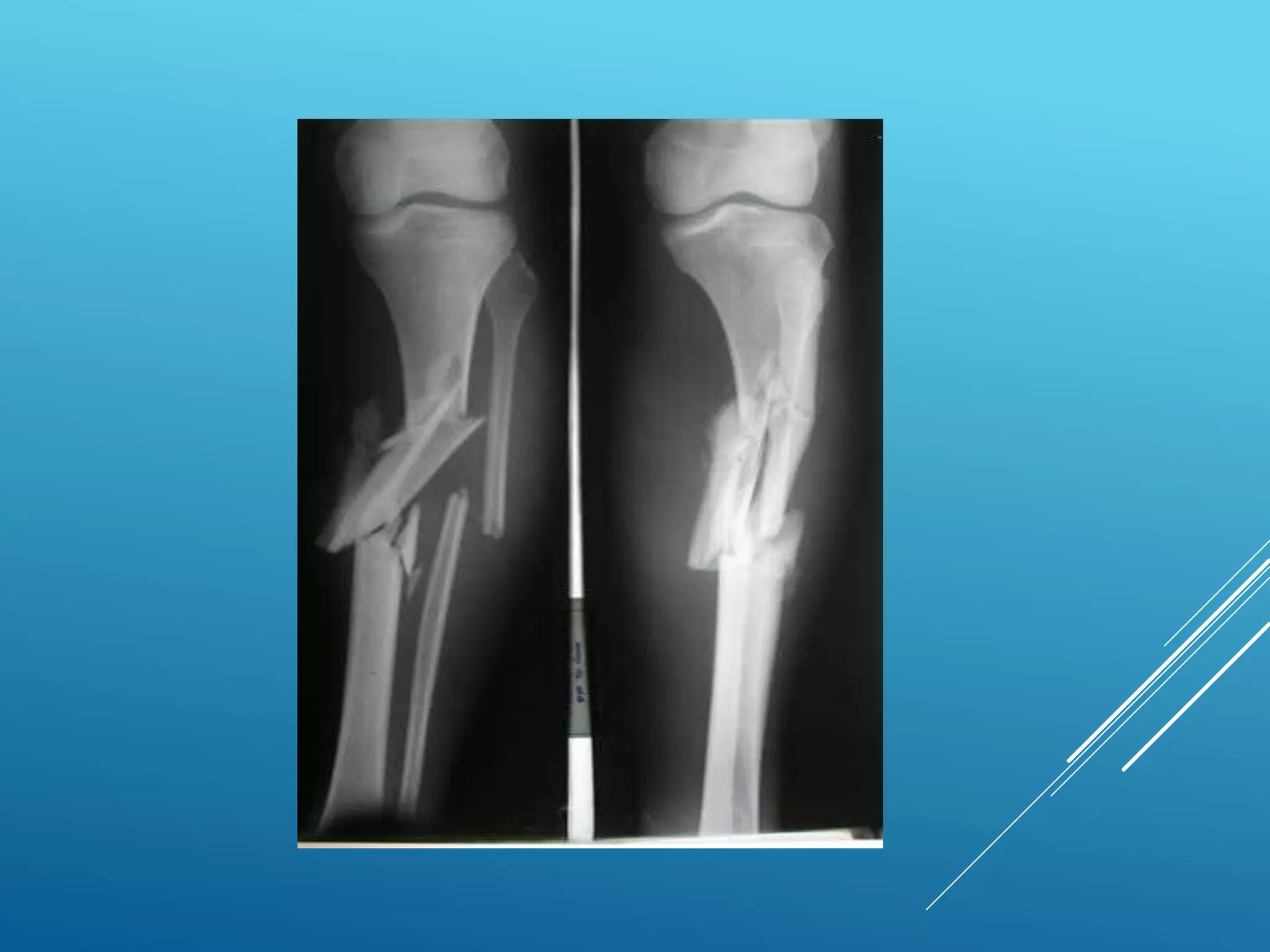blast injury | PPTX