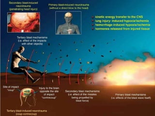 blast injury | PPTX
