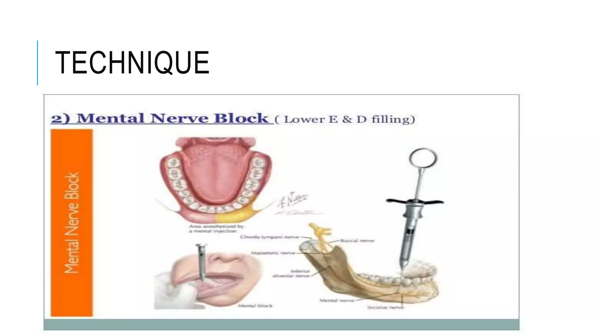 Mandibular Nerve Blocks.pptx