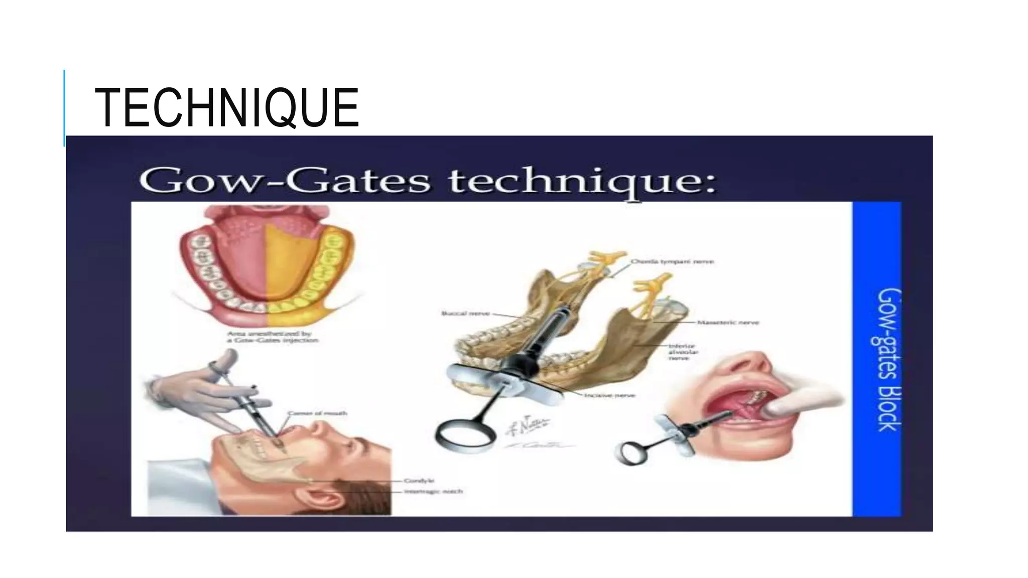Mandibular Nerve Blocks Pptx