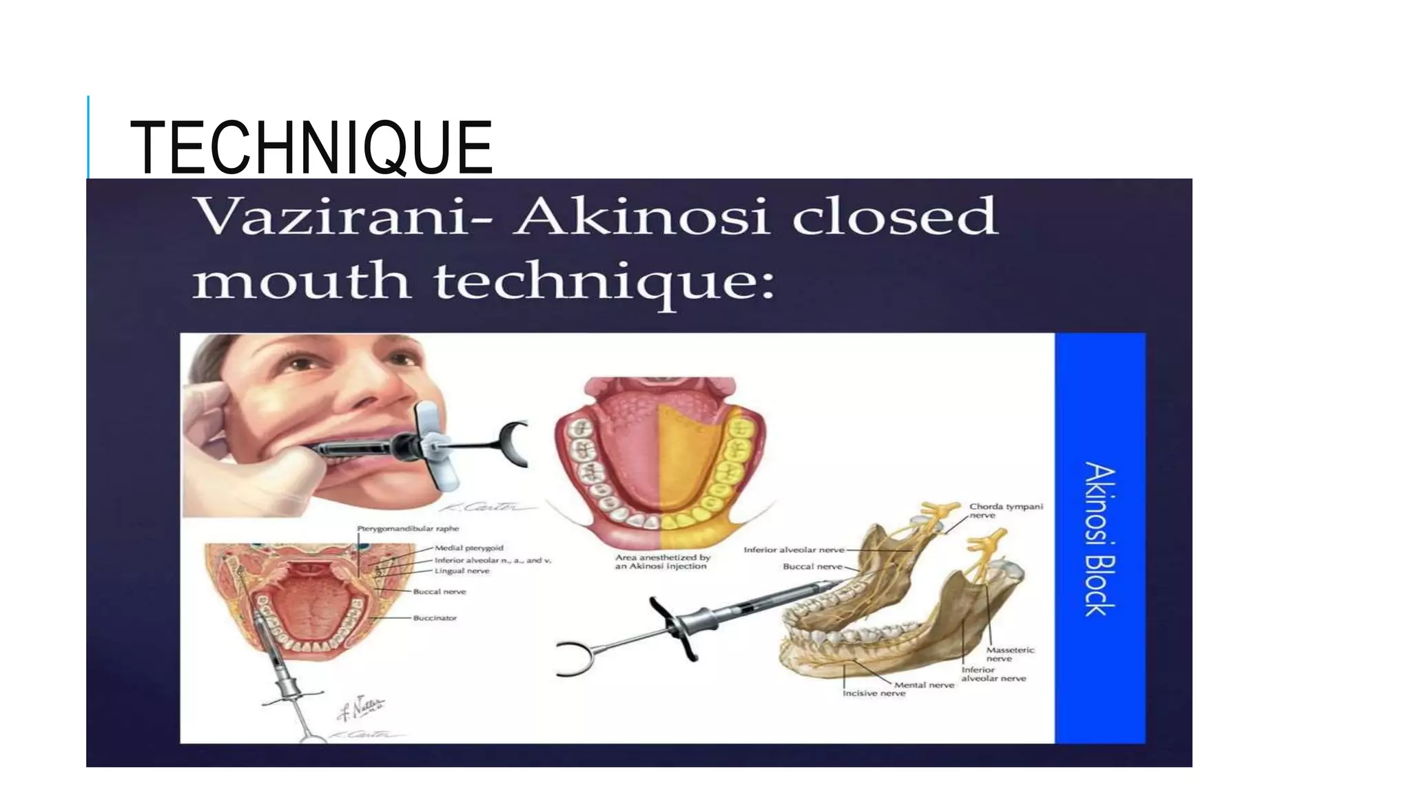 Mandibular Nerve Blocks Pptx