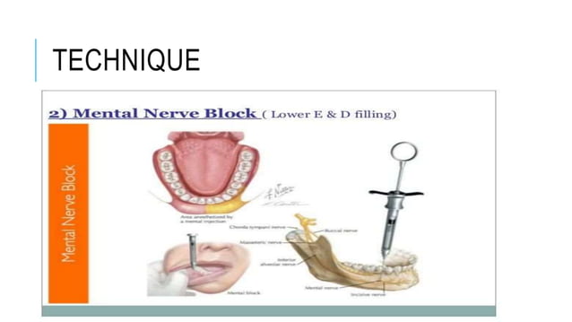 Mandibular Nerve Blocks.pptx