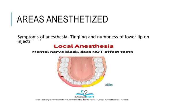 Mandibular Nerve Blocks Pptx