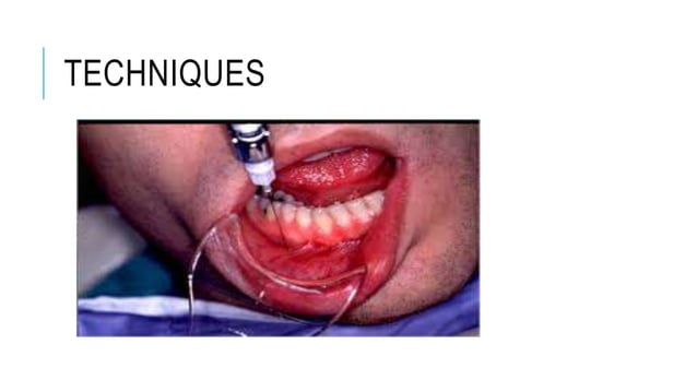 Mandibular Nerve Blocks Pptx