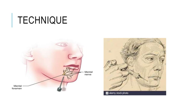 Mandibular Nerve Blocks Pptx