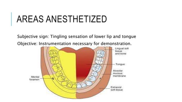 Mandibular Nerve Blocks Pptx