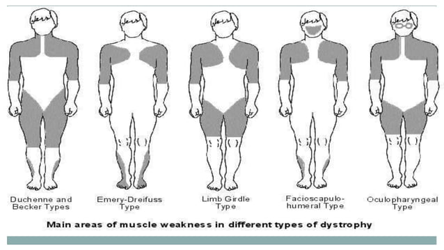 Muscular Dystrophy disorder PPT | PPT