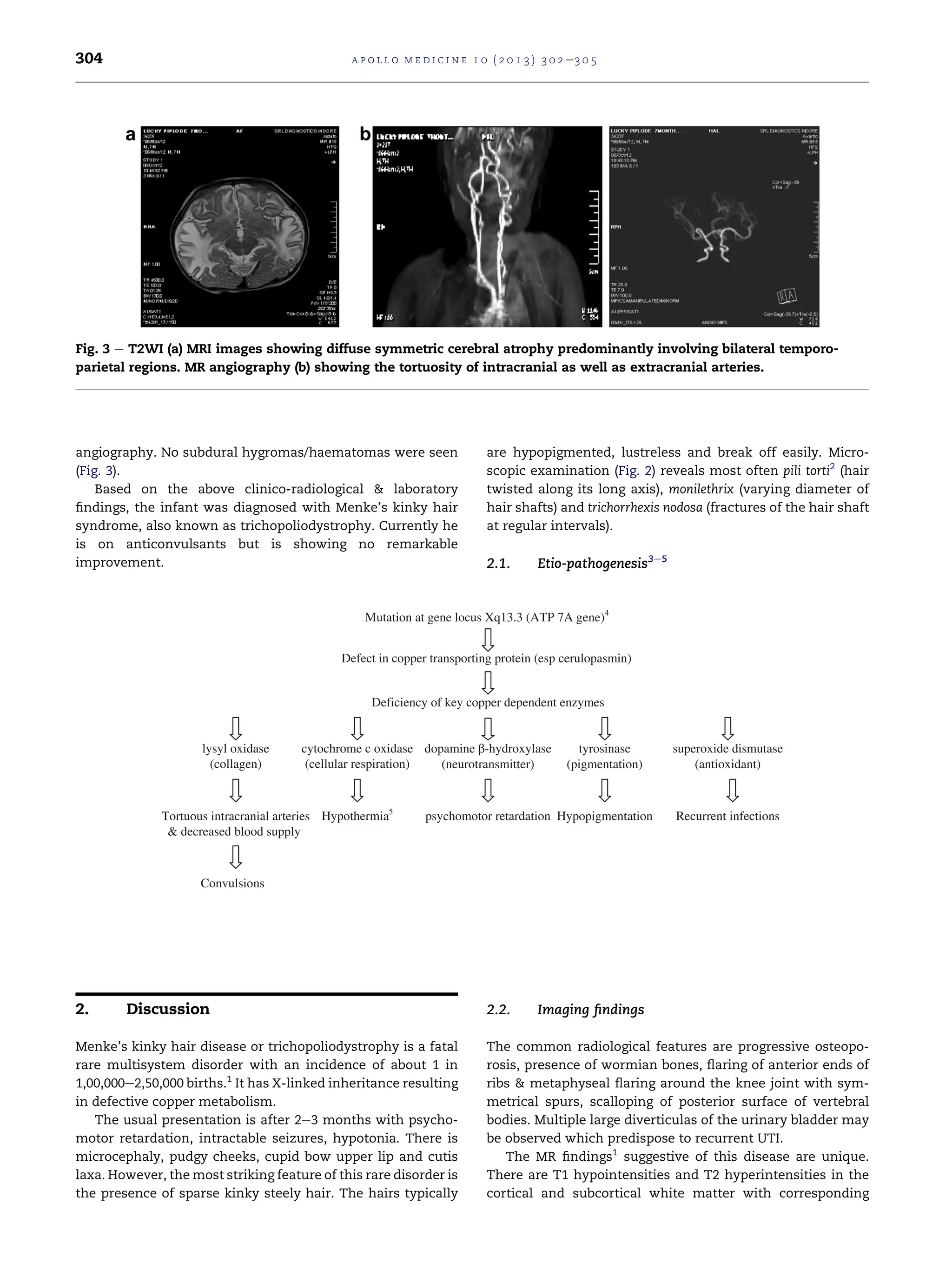 Menke’s Kinky Hair Syndrome - A Spectrum of Clinico-Radiological findings | PDF