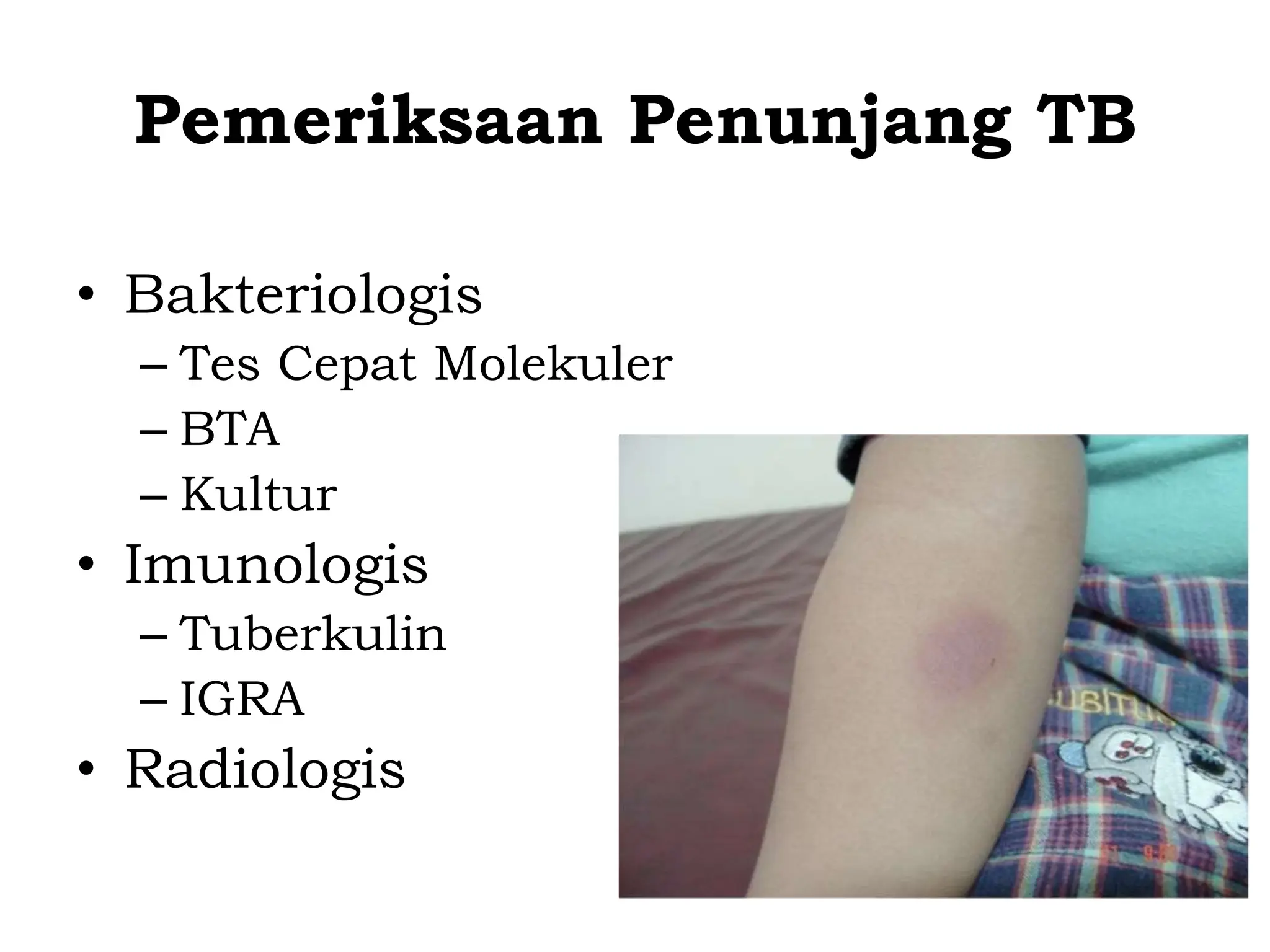 Paparan Tatalaksana Tuberculosis pada Anak | PPTX