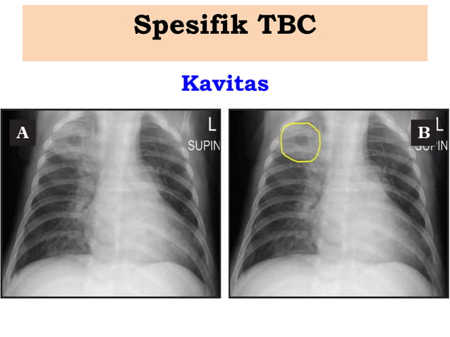 Paparan Tatalaksana Tuberculosis pada Anak | PPTX