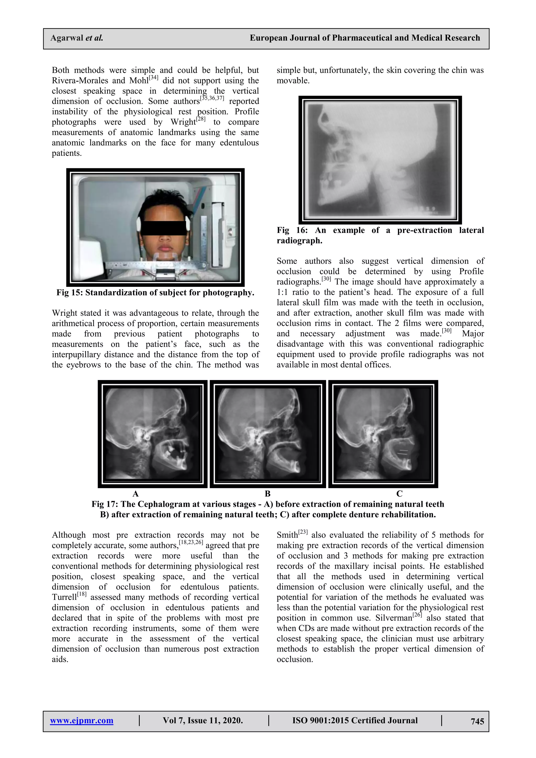 PRE-EXTRACTION RECORDS ARE RELIABLE TOOL FOR COMPLETE DENTURE ...