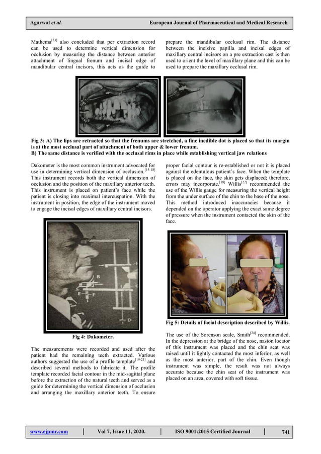 PRE-EXTRACTION RECORDS ARE RELIABLE TOOL FOR COMPLETE DENTURE ...