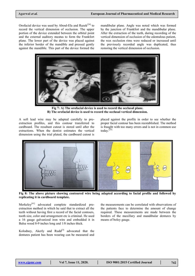 PRE-EXTRACTION RECORDS ARE RELIABLE TOOL FOR COMPLETE DENTURE ...
