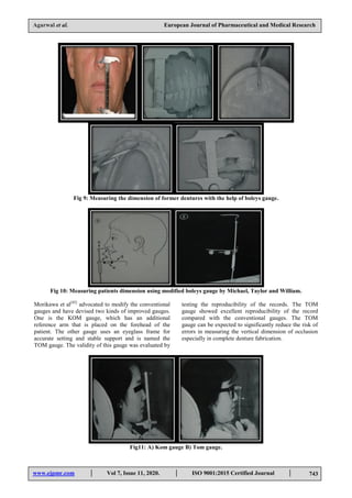 PRE-EXTRACTION RECORDS ARE RELIABLE TOOL FOR COMPLETE DENTURE ...